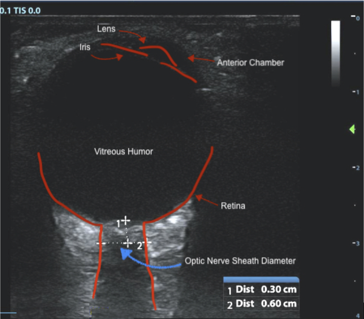 Diagnostics: Ocular Ultrasound — Taming the SRU