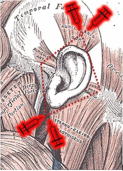 Mastering Minor Care: Auricular Hematoma — Taming the SRU