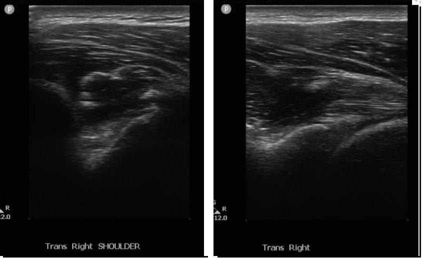 US Case of the Month - Sonography of Shoulders — Taming the SRU