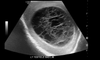 Annals of B Pod - Epididymitis to Pyocele — Taming the SRU