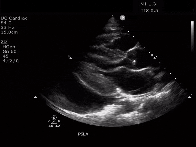 Ultrasound of the Month: Should I Drain That? Lessons on Cardiac ...
