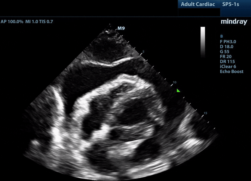 Ultrasound of the Month: Should I Drain That? Lessons on Cardiac ...