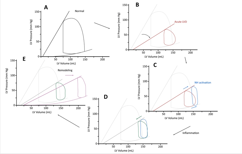 Air Care Series: Pressure-Volume Loop and Impella Support — Taming the SRU