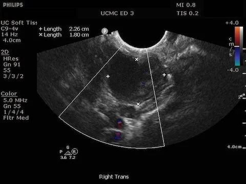 Mastering Minor Care: Peritonsillar Abscess — Taming the SRU