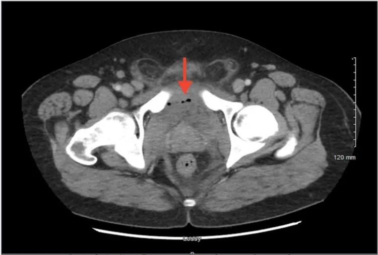 Annals of B Pod: Retzius Abscess — Taming the SRU