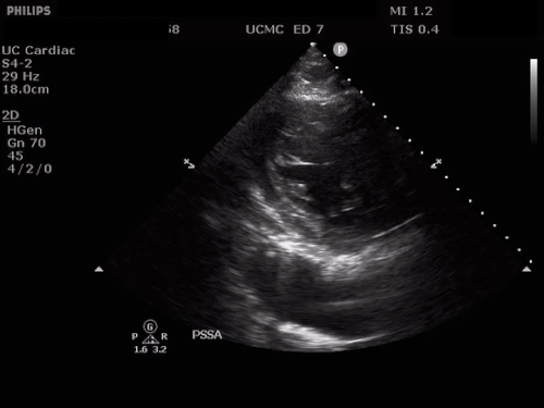 Ultrasound of the Month: Aortic Dissection — Taming the SRU