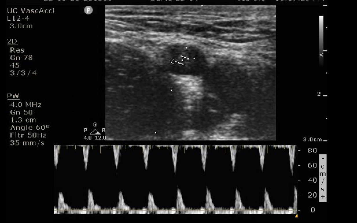 A Finger on the Pulse or An Ultrasound Probe on the Pulse? — Taming the SRU