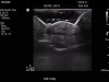 Ultrasound of the Month: Flexor Tenosynovitis — Taming the SRU