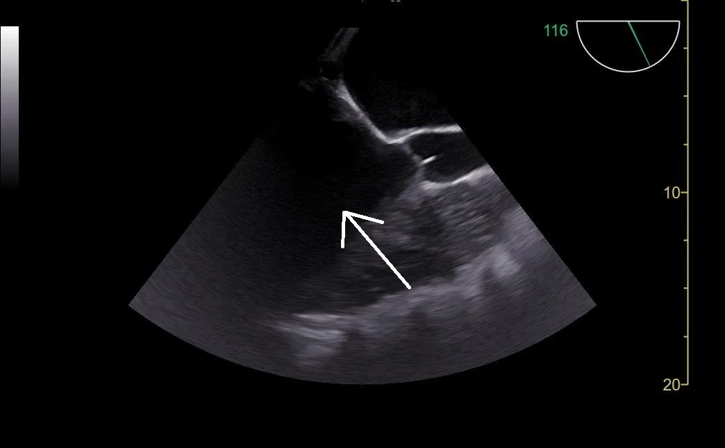 Scanning School - TEE Advanced: Cardiac Arrest Evaluation — Taming the SRU