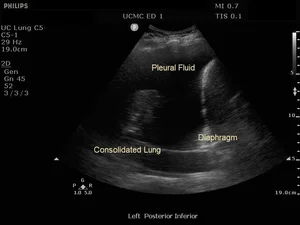 Diagnostics and Therapeutics: Thoracentesis in the Emergency Department ...