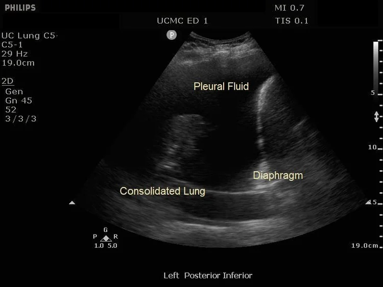 Diagnostics and Therapeutics: Thoracentesis in the Emergency Department ...