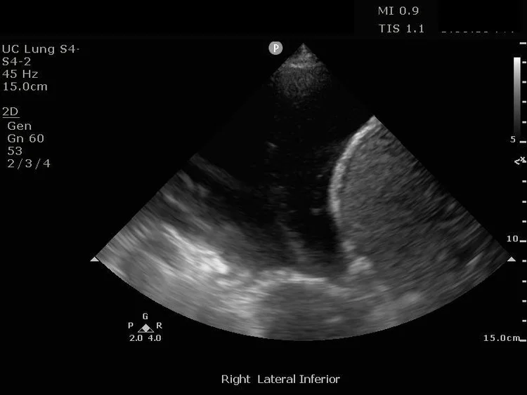 Diagnostics and Therapeutics: Thoracentesis in the Emergency Department ...
