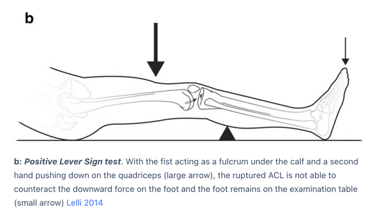 The Lever Test for Diagnosing ACL Injuries — Taming the SRU