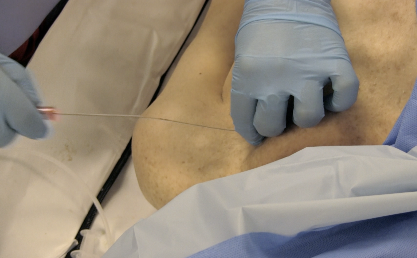 Central Line — Taming the SRU