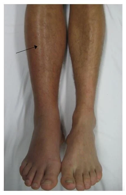 Diagnostics: Thromboembolic Disease in Pregnancy — Taming the SRU