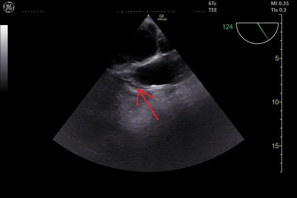 Scanning School - TEE Advanced: Cardiac Arrest Evaluation — Taming the SRU