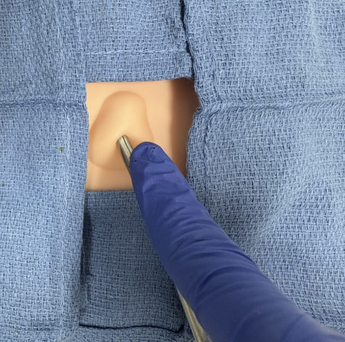 Mastering Minor Care: Bartholin Gland Abscess — Taming the SRU