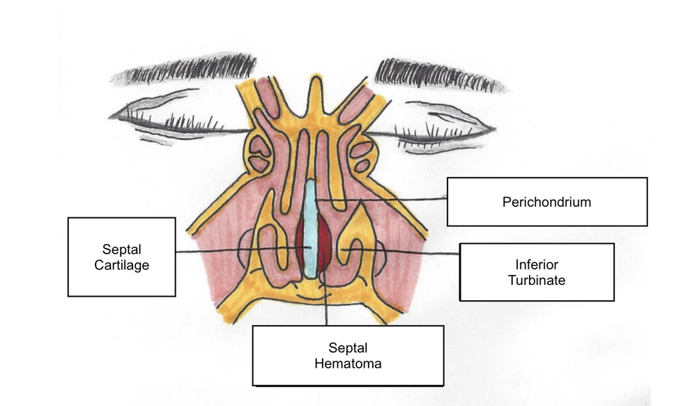 Mastering Minor Care: Nasal Septal Hematoma — Taming the SRU