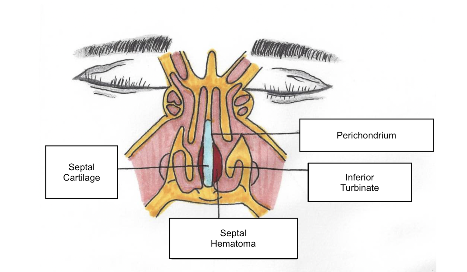 Mastering Minor Care: Nasal Septal Hematoma — Taming the SRU