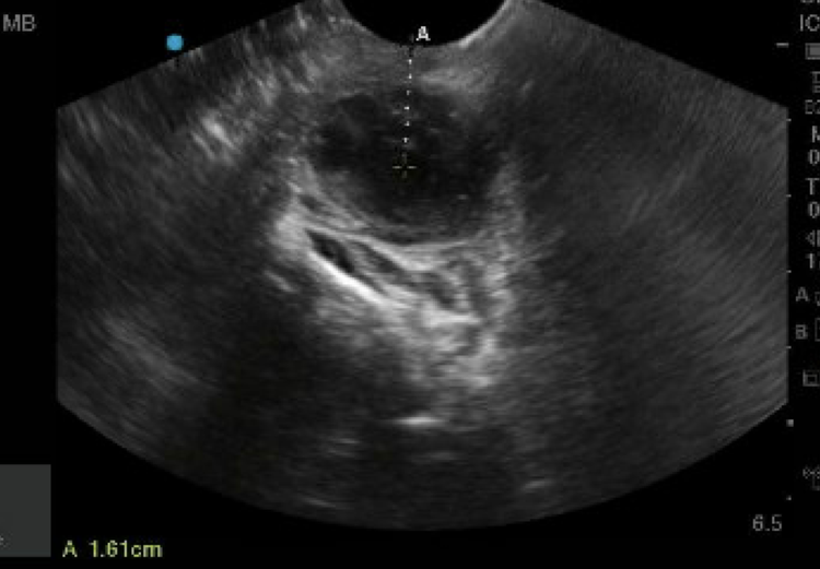Ultrasound of the Month: Peritonsillar Abscess — Taming the SRU