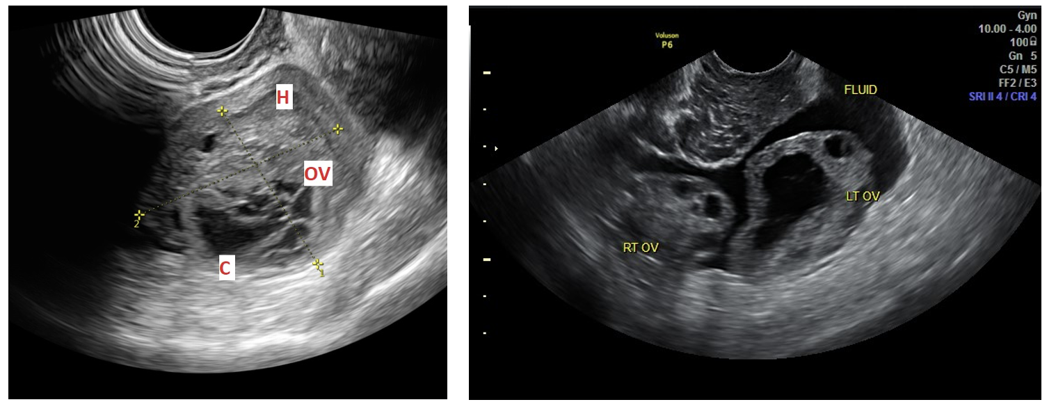 Ovarian Emergencies: Can't Miss Diagnoses — Taming the SRU