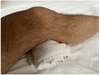 Mastering Minor Care: Knee Arthrocentesis — Taming the SRU