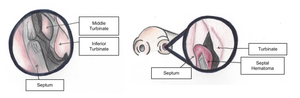 Mastering Minor Care: Nasal Septal Hematoma — Taming the SRU