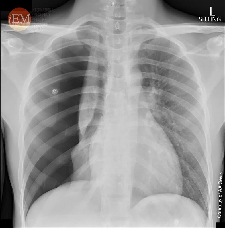 Diagnostics and Therapeutics: Managing Pneumothorax — Taming the SRU