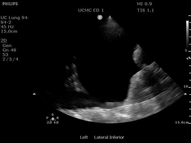 Diagnostics and Therapeutics: Thoracentesis in the Emergency Department ...