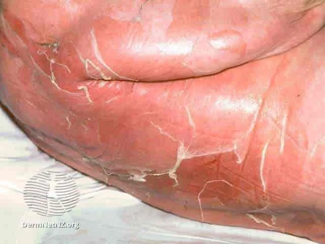 Bullous Skin Lesions, Meet Emergency Medicine — Taming the SRU