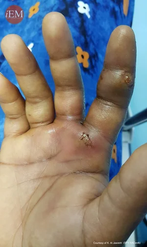 Ultrasound of the Month: Flexor Tenosynovitis — Taming the SRU