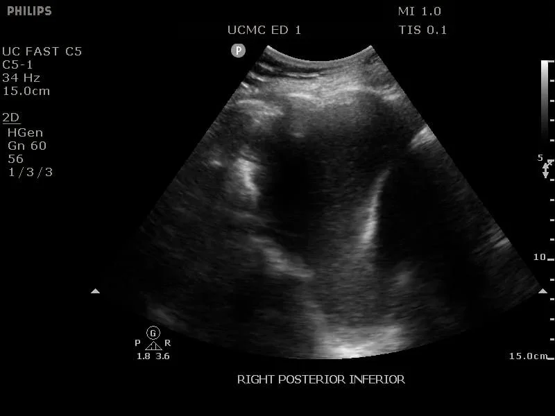Diagnostics and Therapeutics: Thoracentesis in the Emergency Department ...