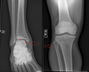 Twists and Turns: Identifying Maisonneuve Fractures in the ED — Taming ...