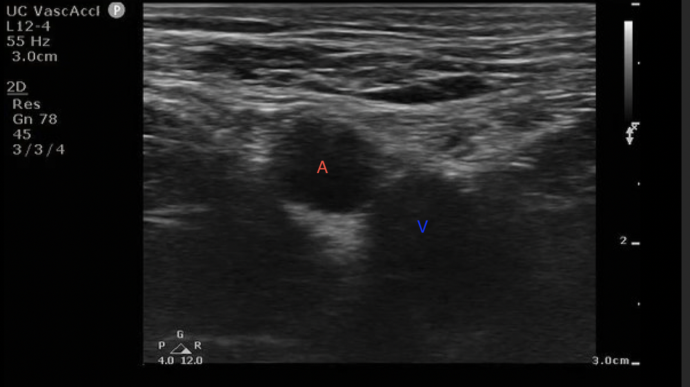 A Finger on the Pulse or An Ultrasound Probe on the Pulse? — Taming the SRU