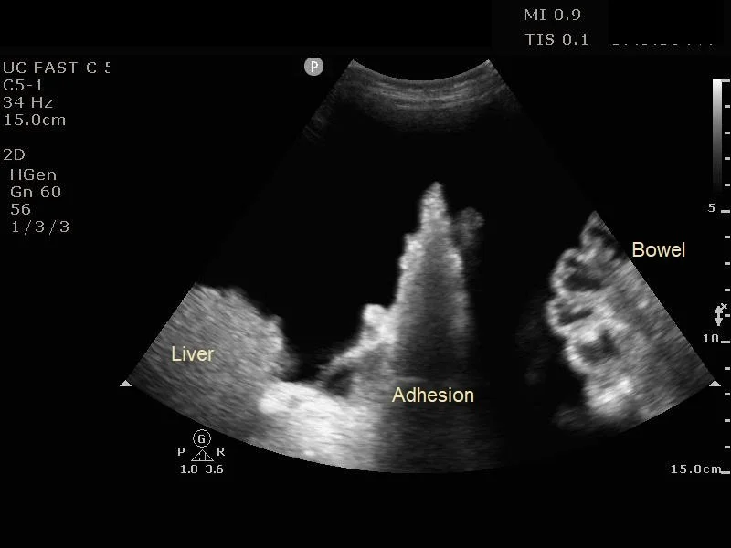 Diagnostics and Therapeutics: Paracentesis in the Emergency Department ...