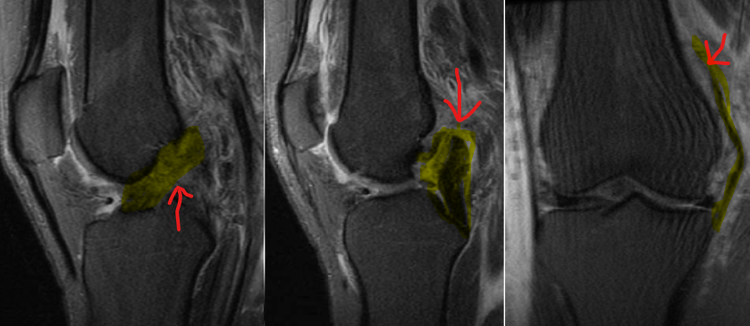 Consultant Corner: Acute Management of the Dislocated Knee — Taming the SRU