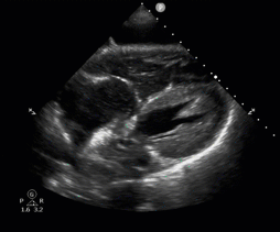 POCUS in Cardiac Arrest — Taming the SRU
