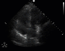 POCUS in Cardiac Arrest — Taming the SRU