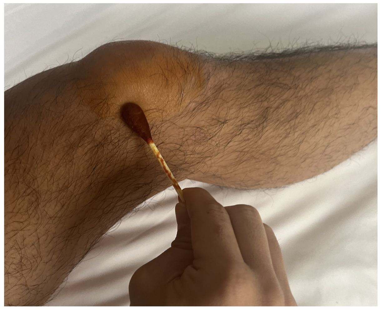 Mastering Minor Care: Knee Arthrocentesis — Taming the SRU