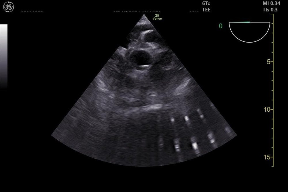Scanning School - TEE Advanced: Cardiac Arrest Evaluation — Taming the SRU