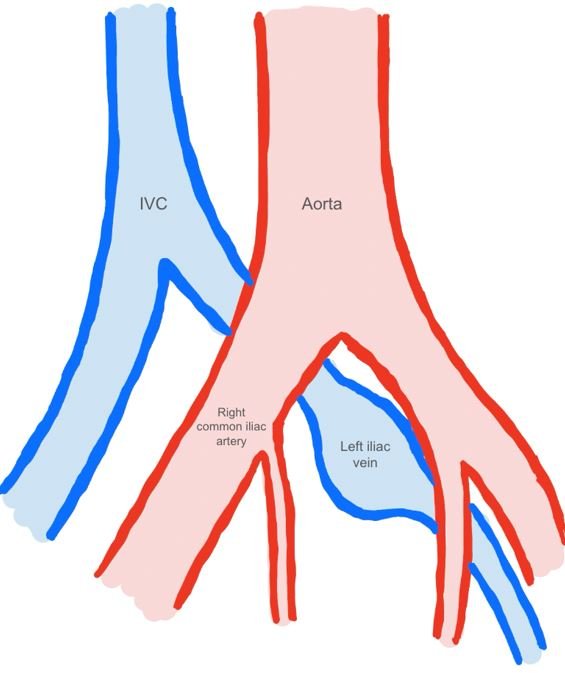 Diagnostics: Thromboembolic Disease in Pregnancy — Taming the SRU
