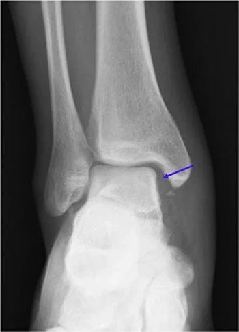 Twists and Turns: Identifying Maisonneuve Fractures in the ED — Taming ...