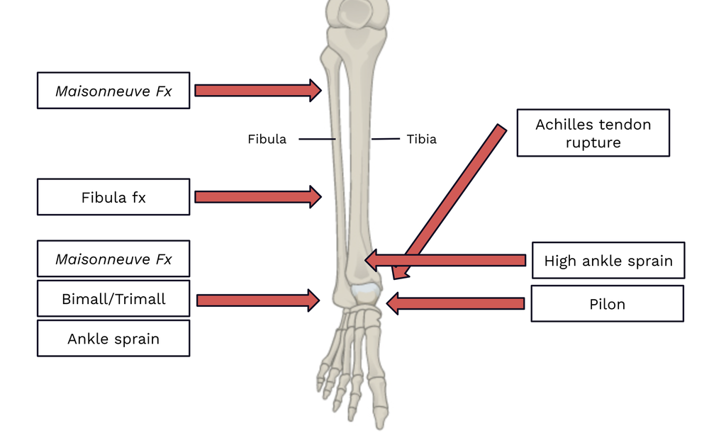 Twisting and Turning - Ankle Injuries in the ED — Taming the SRU