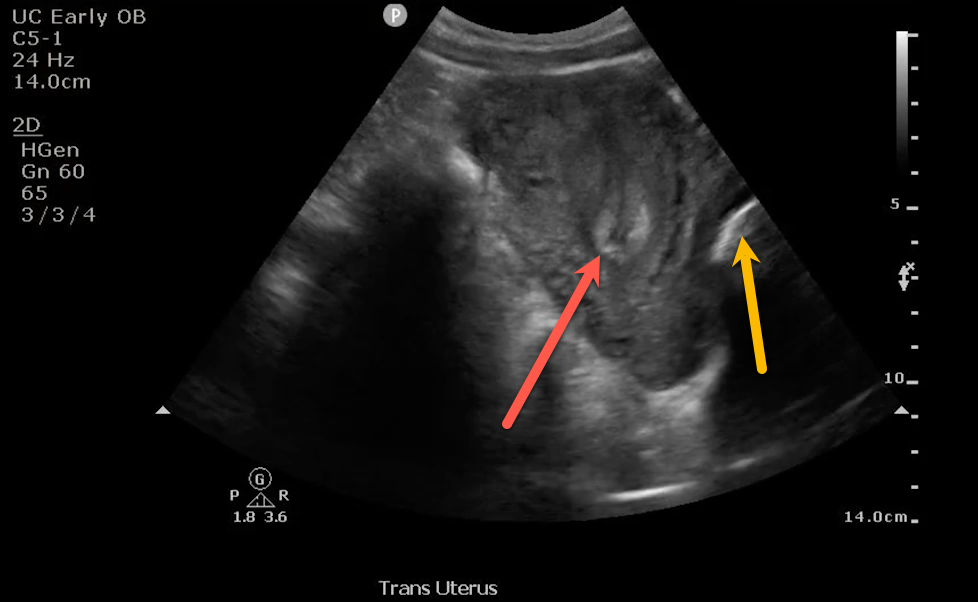 Ultrasound of the Month: No Definitive Yolk Sac, No Definitive IUP ...