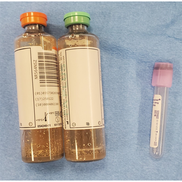 Diagnostics and Therapeutics: Paracentesis in the Emergency Department ...