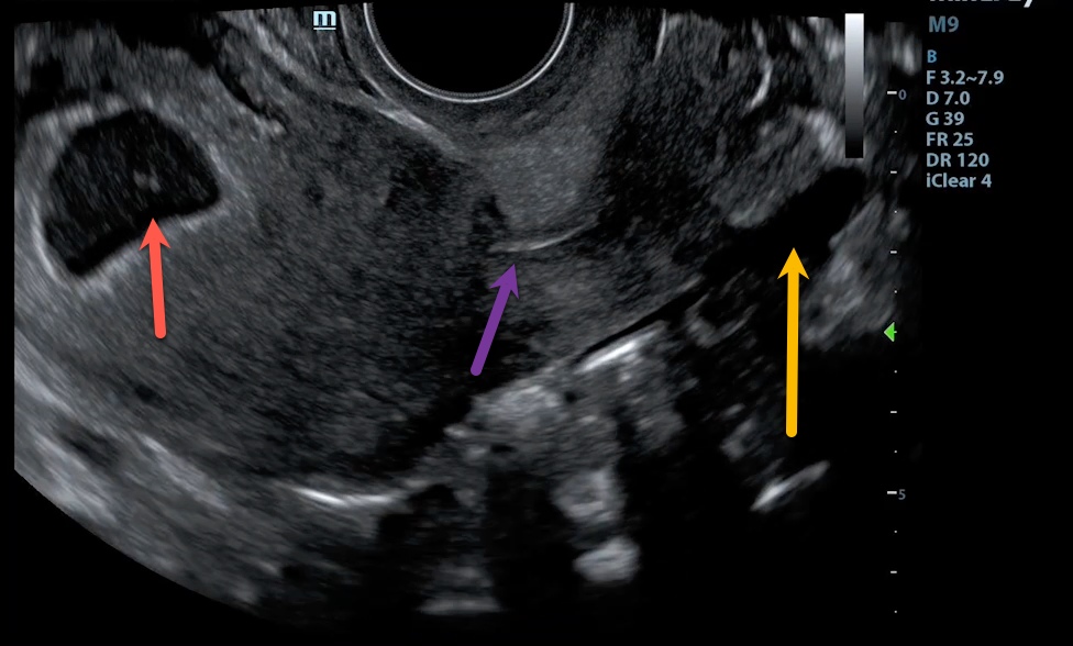Ultrasound of the Month: No Definitive Yolk Sac, No Definitive IUP ...