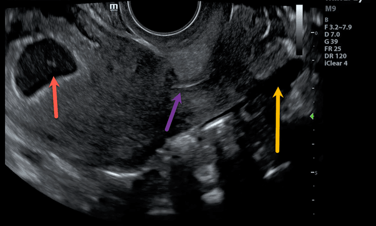 Ultrasound of the Month: No Definitive Yolk Sac, No Definitive IUP ...