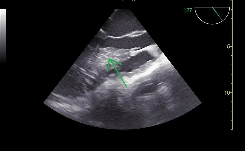 Scanning School - TEE Advanced: Cardiac Arrest Evaluation — Taming the SRU