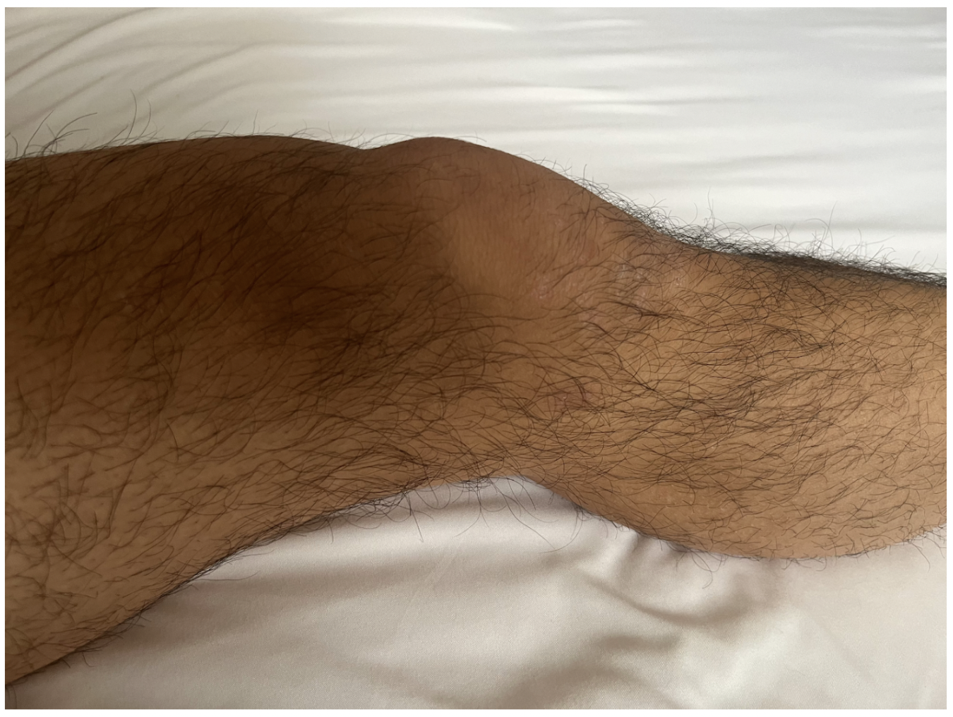 Mastering Minor Care: Knee Arthrocentesis — Taming the SRU