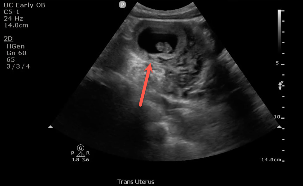 Ultrasound of the Month: No Definitive Yolk Sac, No Definitive IUP ...
